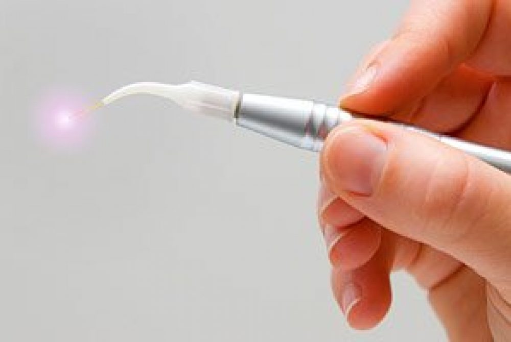 Laser Dentistry - Dental Flossophy